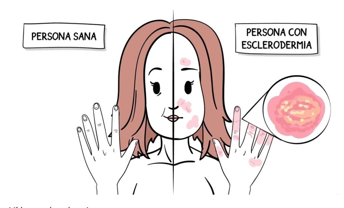 Esclerodermia: qué es, síntomas, diagnóstico y tratamiento