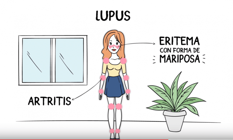 Lupus Eritematoso Sistémico (LES): qué es, síntomas, diagnóstico y ...