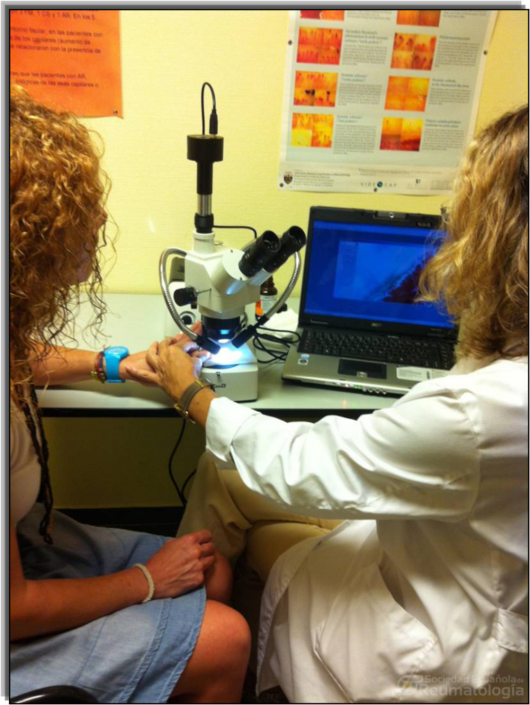 Capilaroscopia - Inforeuma