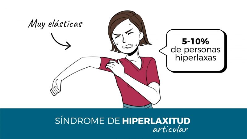 Hiperlaxitud articular: qué es, síntomas y tratamiento